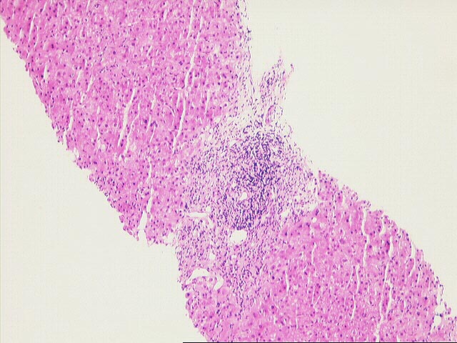 Allograft Liver, Needle Biopsy - Case 57