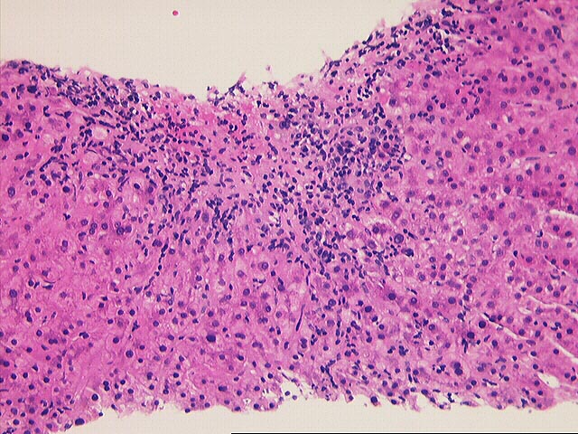 Allograft Liver, Needle Biopsy - Case 57