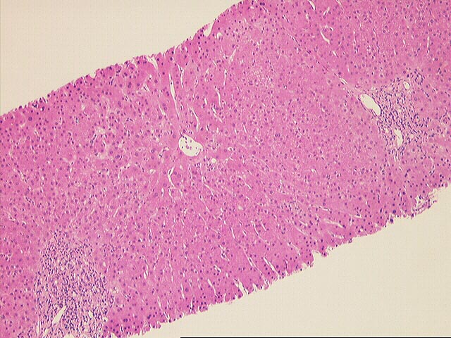Allograft Liver, Needle Biopsy - Case 57