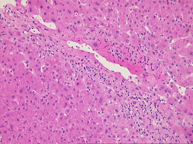 Allograft Liver, Needle Biopsy - Case 57